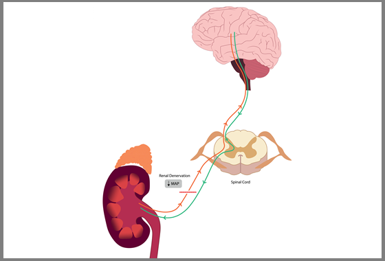 Renal Denervation | Lippincott NursingCenter