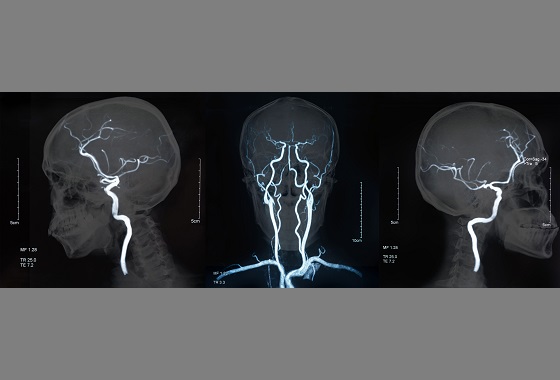 Calculating Cerebral Perfusion Pressure Nursingcenter