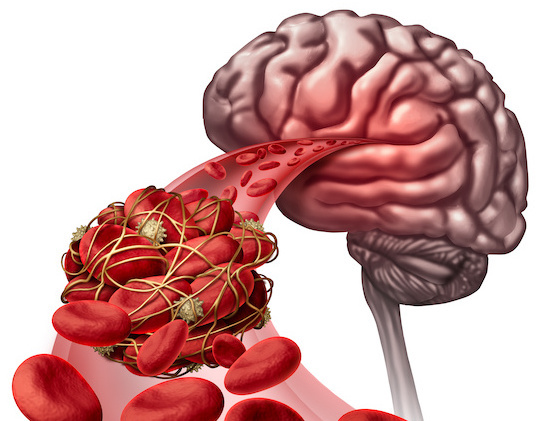 Alteplase – How Does It Work? |Lippincott NursingCenter